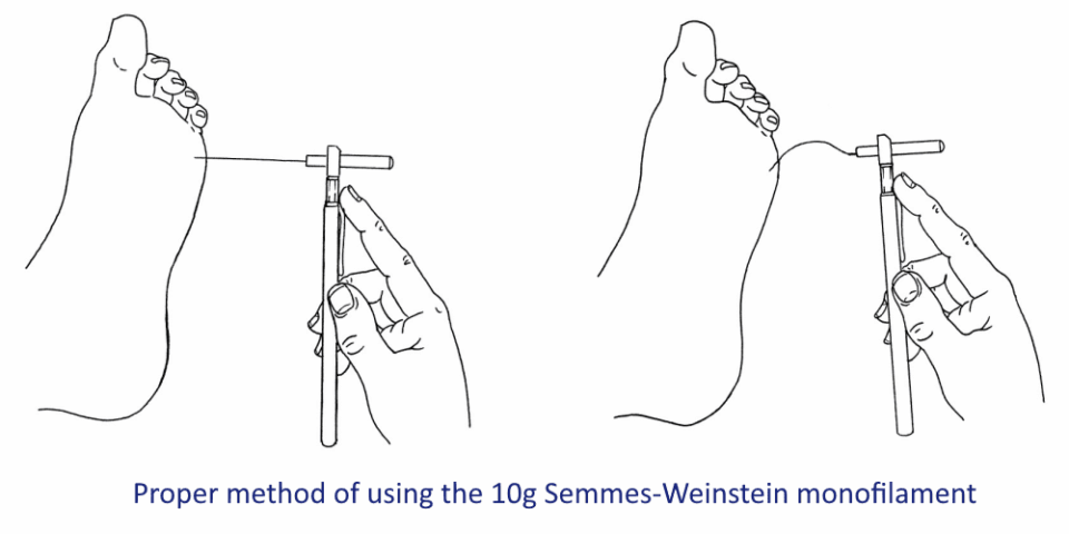 Phát Hiện Mất Cảm Giác Bằng Monofilament 3 điểm